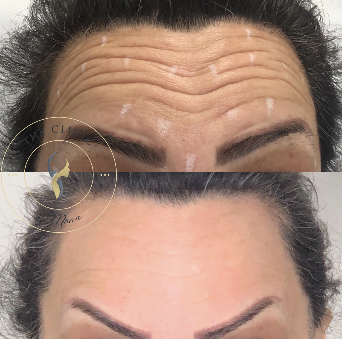 Botox for the first time? What to expect - The Clinic by Mona