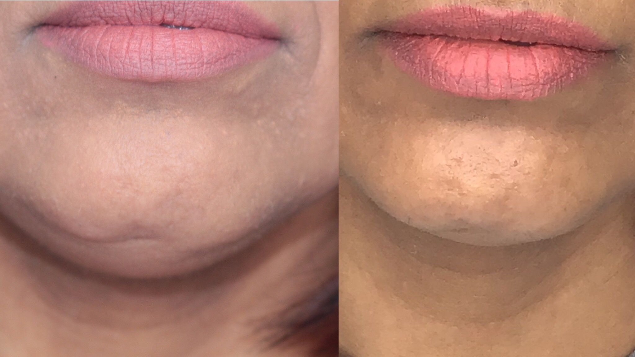 HI-FU for the first time? What to expect - The Clinic by Mona